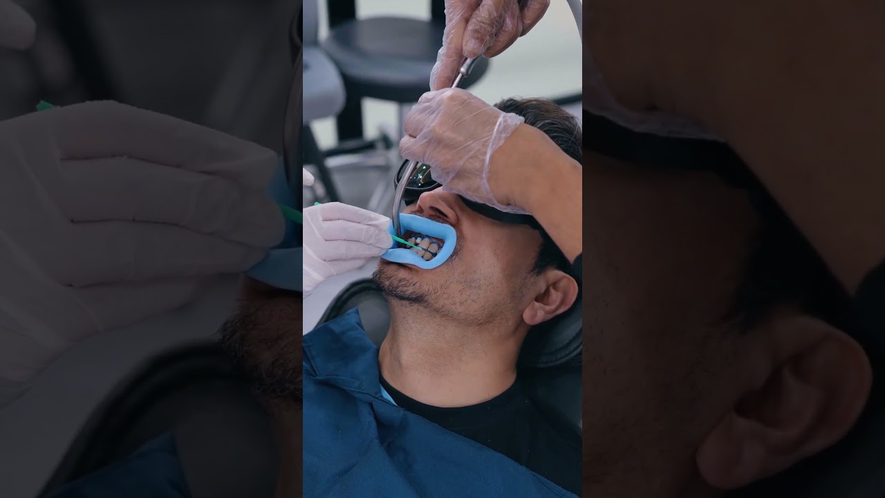 Composite Bonding Teeth Veneers Procedure Before And After | Smile Makeover | Best Dentist