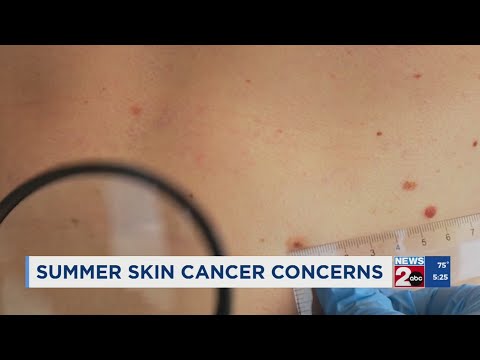 Summer skin cancer concerns