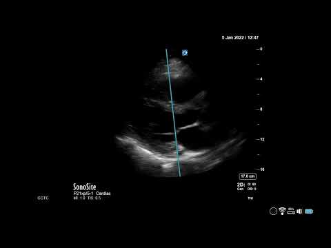 Week 2 – Introduction to Left Ventricular Systolic Function – IM+CC US ...