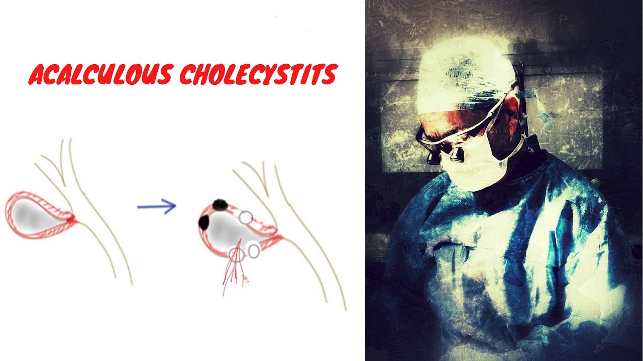 Acalculous Gallbladder Disease