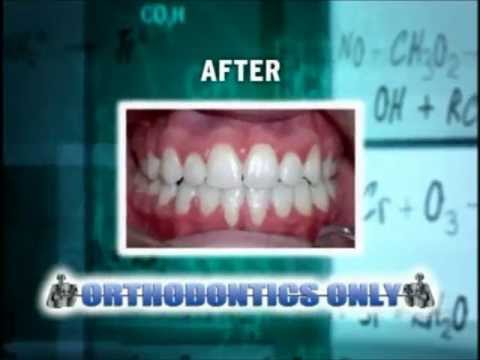 Before and After Braces - Incredible results