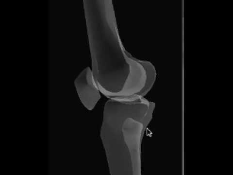 Lateral Knee