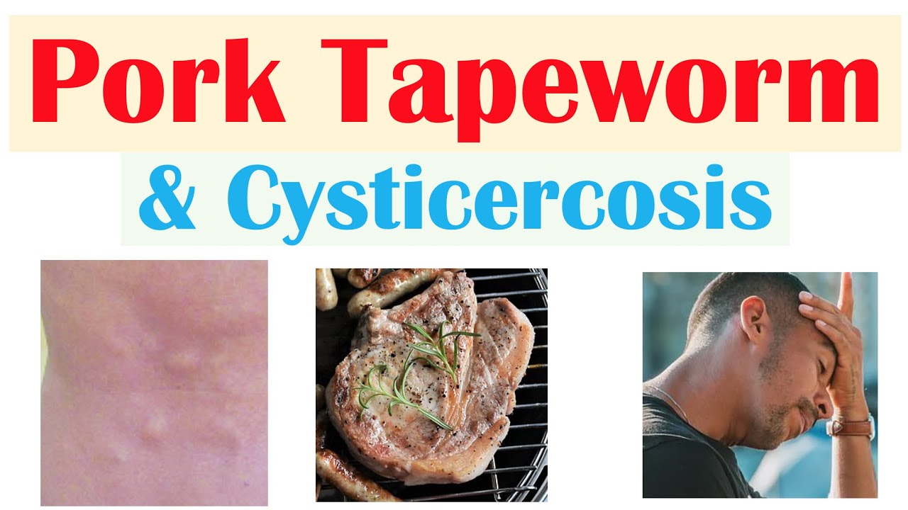 Pork Tapeworm (Taeniasis) | How It Infects, Symptoms & Cysticercosis, Diagnosis, Treatment