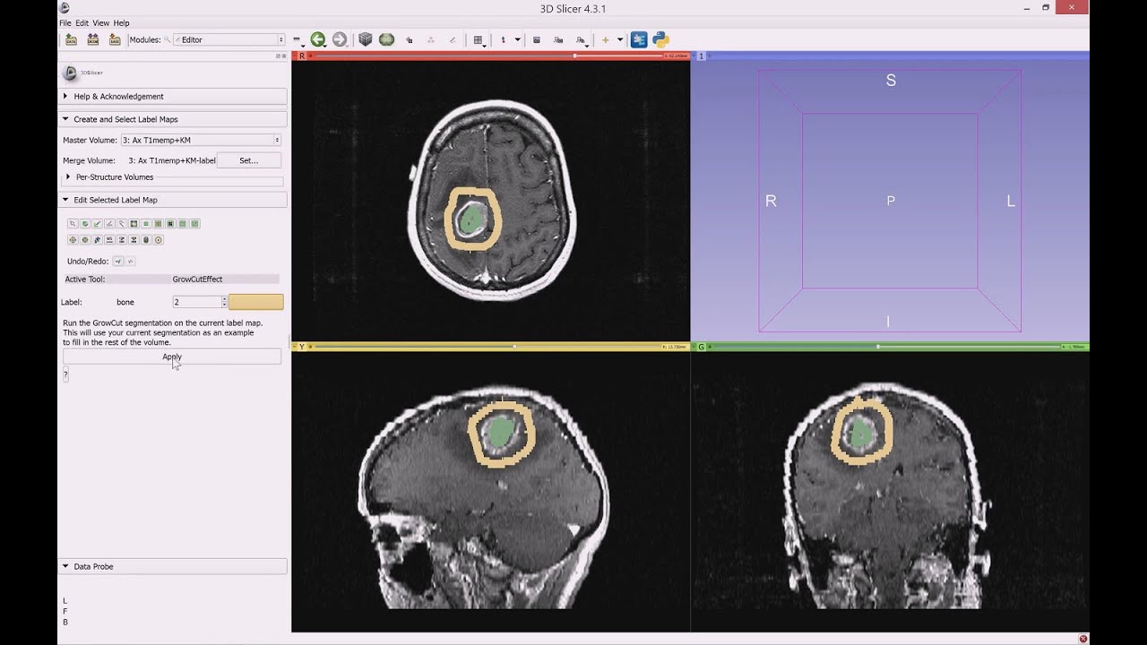 How to Tutorial Video: GBM Volumetry using the 3D Slicer Medical Image Computing Platform