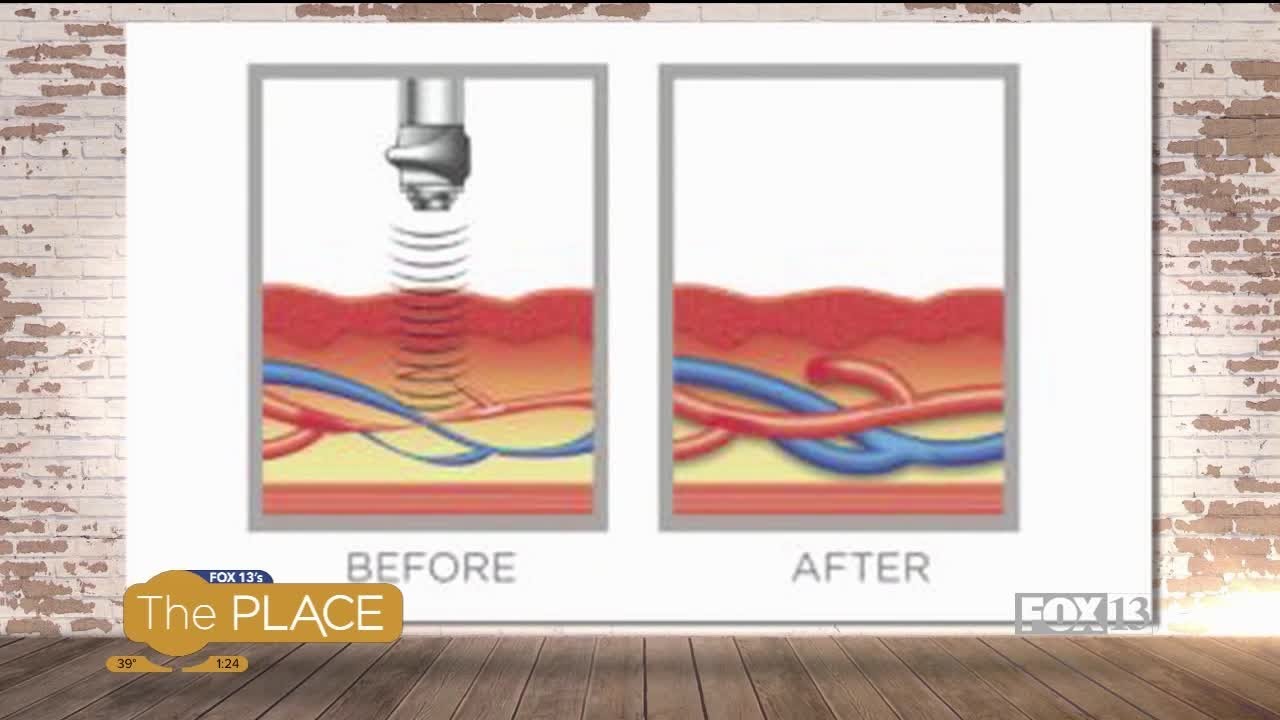 Acoustic Wave Therapy could fix your E.D.