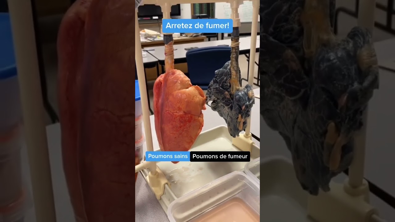 Do you smoke? Well, here's why you should stop... #tobacco #smoking #cancer #medicine #health #me...