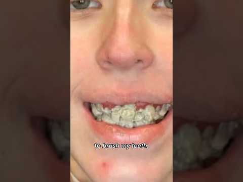 She Hasn't Brushed Her Teeth In YEARS! 😳🦷