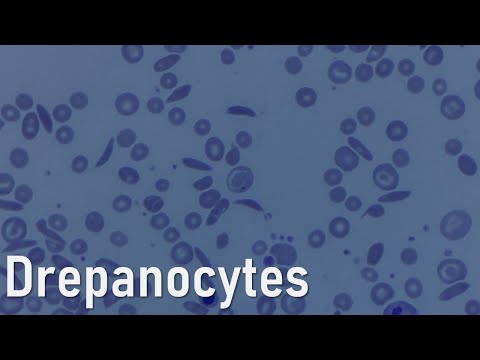 Red cells: Drepanocytes (sickle cells)