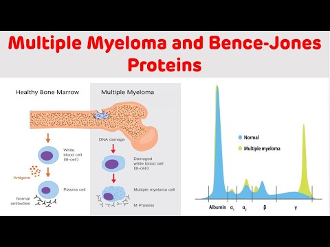 Multiple Myeloma and Bence Jones Proteins