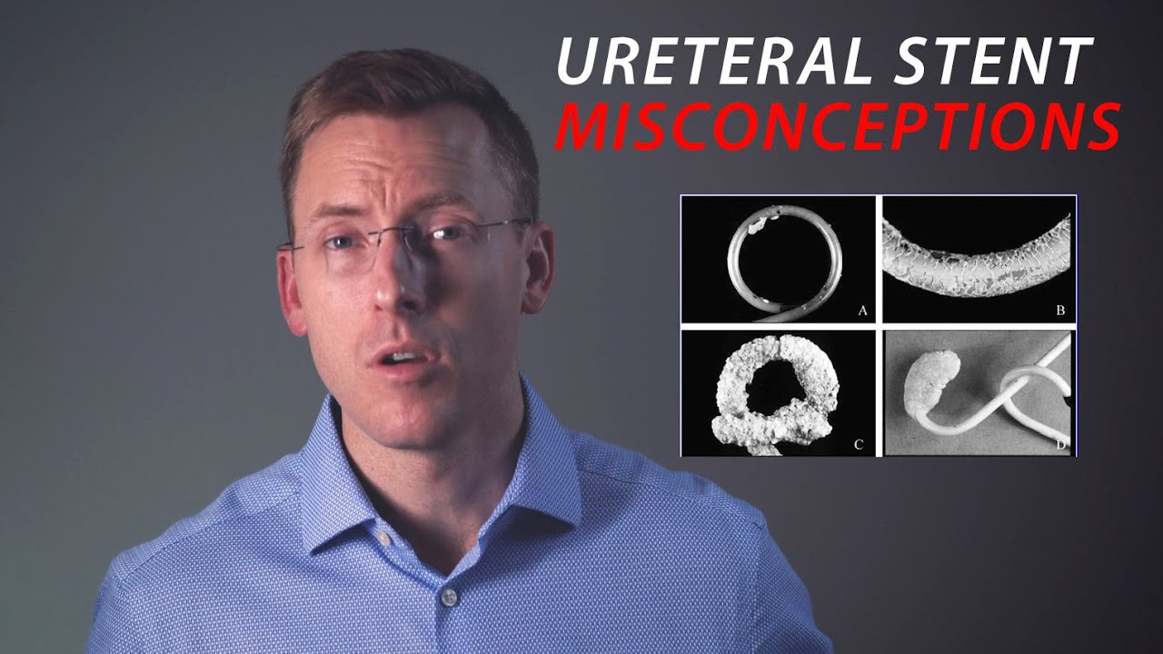 Ureteral Stent Misconceptions