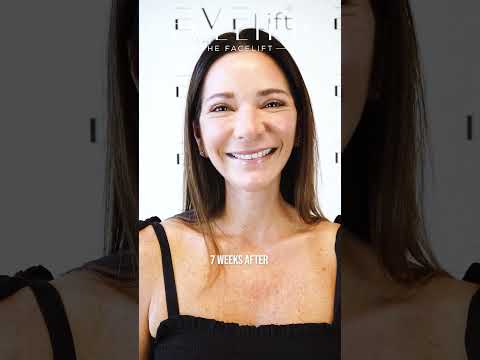 EVE Lift™ Patient Donna Before and 7 Weeks After | Eden Plastic Surgery: Dr. Ali Charafeddine, MD