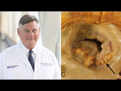 Surgeon Q&A: Mitral Annular Calcification: What Should Patients Know?