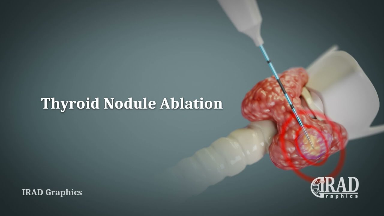 Thyroid Nodule Ablation