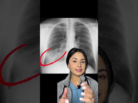 Chest X-Rays 🩻