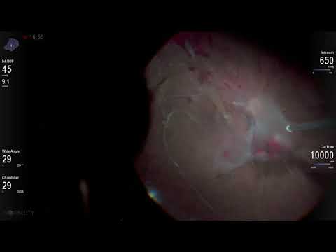BASICS OF DIABETIC TRACTIONAL RETINAL DETACHMENT REPAIR
