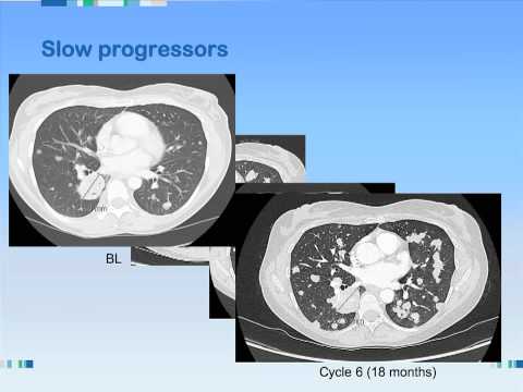 Should RECIST-PD Lead to a Change of Treatment? Laure Fournier, M.D.