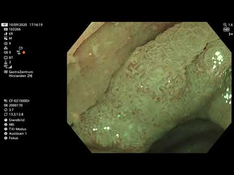 Sessile Serrated Adenoma Detection and Diagnosis in TXI and NBI