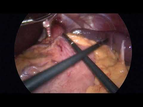 Laparoscopic placement of a Linx antireflux device Surgery