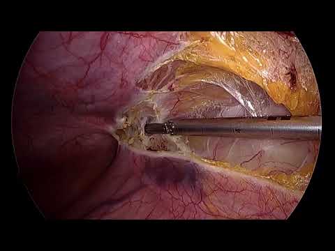 Laparoscopic resection of primary peritoneal lieomyoma Rajesh Patil