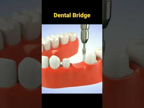 Dental bridge || tooth bridge // zirconia crowns #shorts #youtubeshorts #shortsvideo