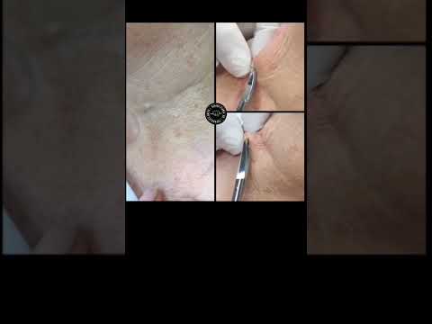 Dr Pimple Popper Reveals Skin Tag Removal Technique