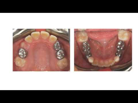 Clinical Case: When would you consider serial extraction? (VIDEO ...