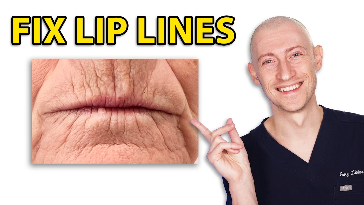 How to FIX Lip Lines | Treatments for Lip Wrinkles