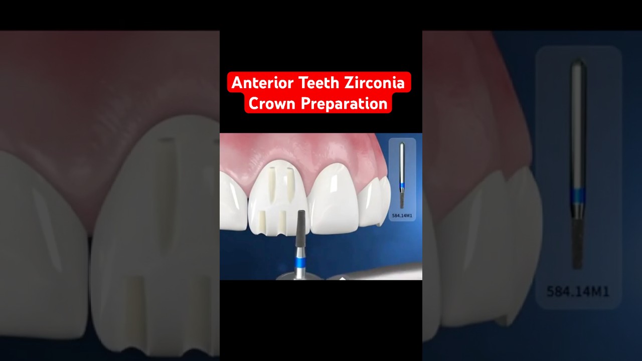 Anterior Teeth Crown Preparation #dentalcrown #dental #dentaltips #dentist #fyp #shortsfeed