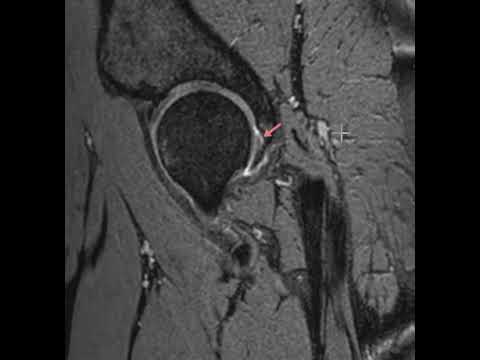 Tear of the posterior hip labrum