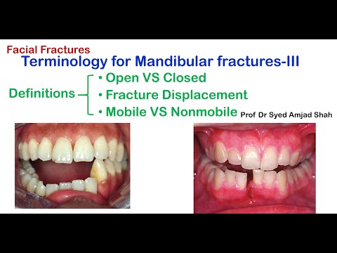 Definition Open vs Closed Fractures | Mandibular Fractures | Syed Amjad Shah