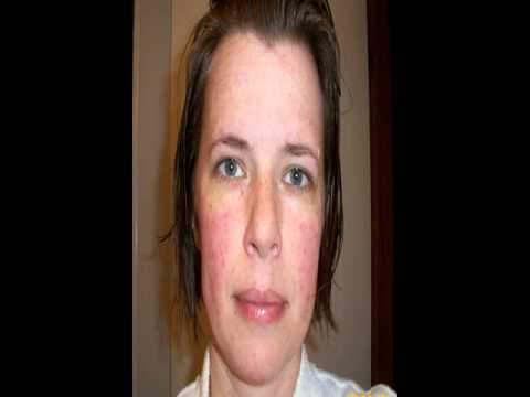 best makeup for rosacea
