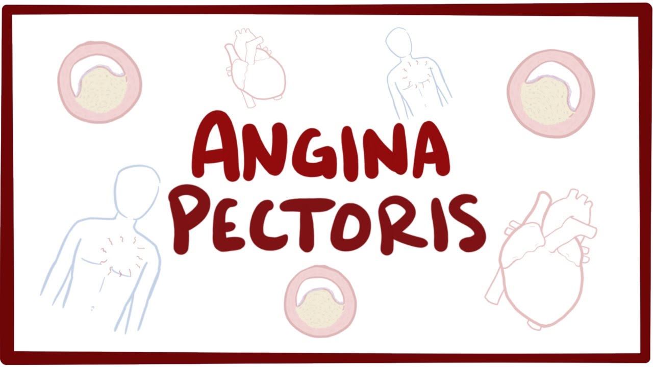 Understanding Angina Pectoris: Types, Symptoms, and Pathology | Galaxy.ai