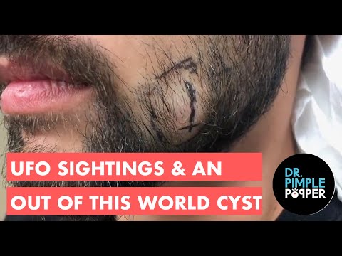 Dr. Pimple Popper Pops 'UFO' Cyst From Beard In New Youtube Video