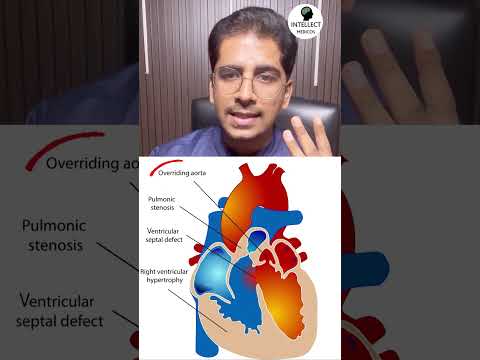 Tetralogy of Fallot (TOF) #cardiology #pediatrics #shorts