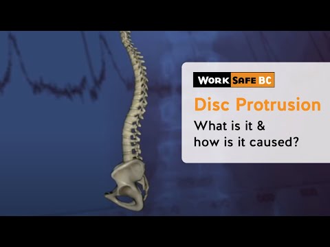 Disc Protrusion | WorkSafeBC