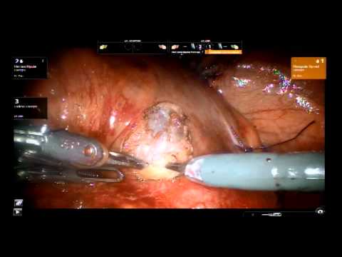 Robotic Ureteral Reimplant / Ureteral Neocystostomy