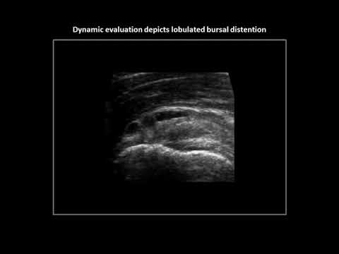 Lobulated subacromial-subdeltoid bursitis on shoulder ultrasound