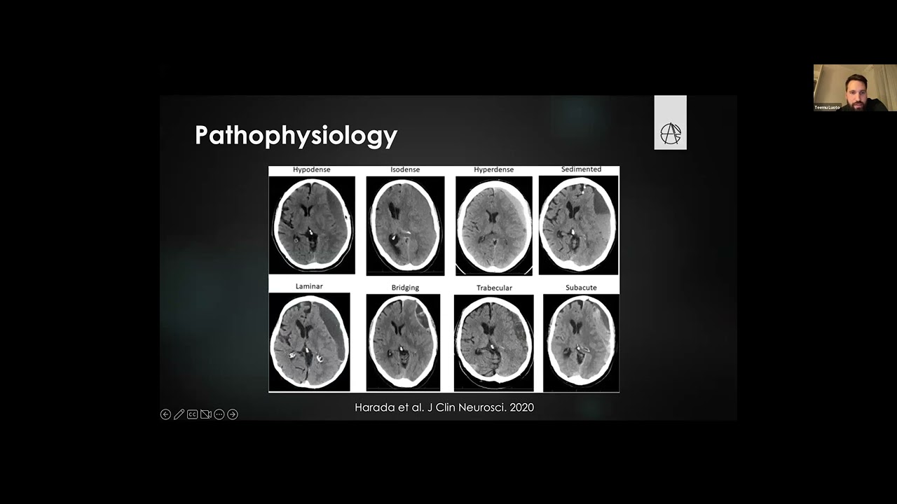 EANS WEBINARS: CHRONIC SUBDURAL HEMATOMAS (CSDH)