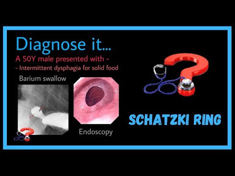 50 Y male with dysphagia - Schatzki Ring
