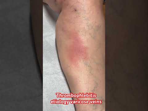 Thrombophlebitis caused by varicose veins #veins