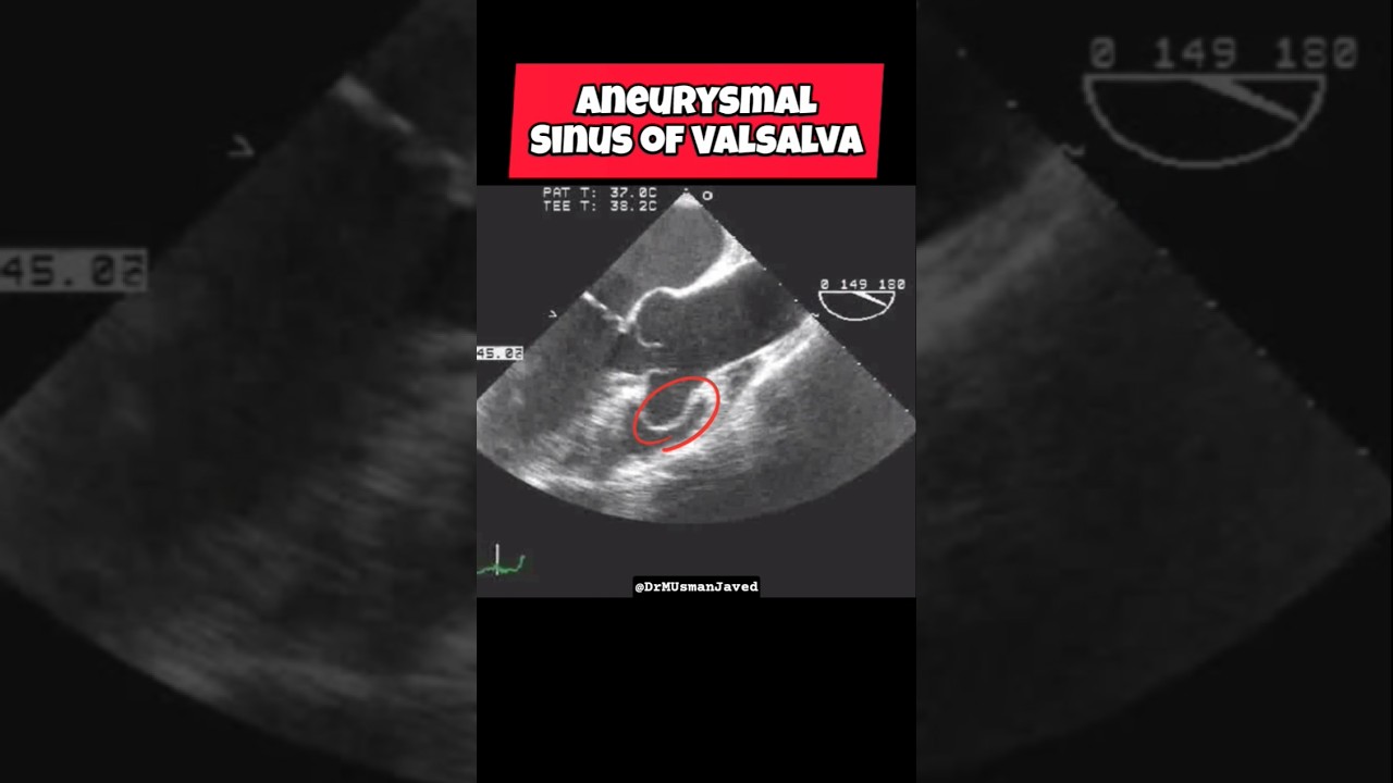Sinus Of Valsalva Aneurysm on Echo