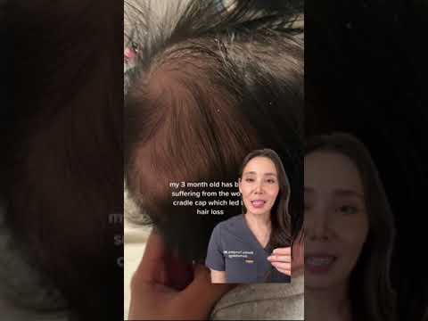Balding from seborrheic dermatitis
