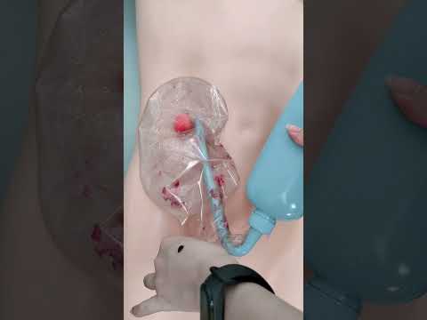 How to clean the one-piece ostomy bag