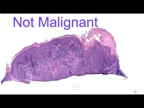 Benign or Malignant? - Watch To Find Out (Desmoplastic Trichilemmoma)