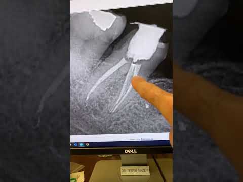 Two root canals in one appointment.