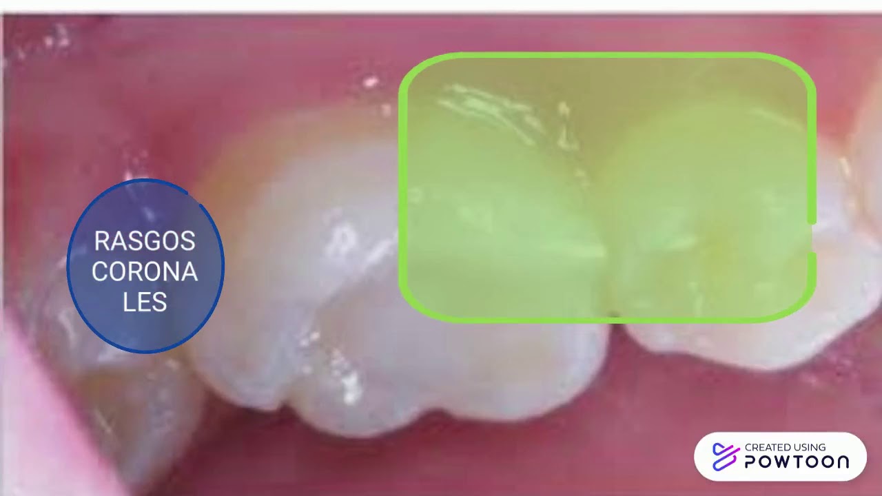 DIFERENCIAS DE LA DENTICION TEMPORAL Y PERMANENTE.pptx