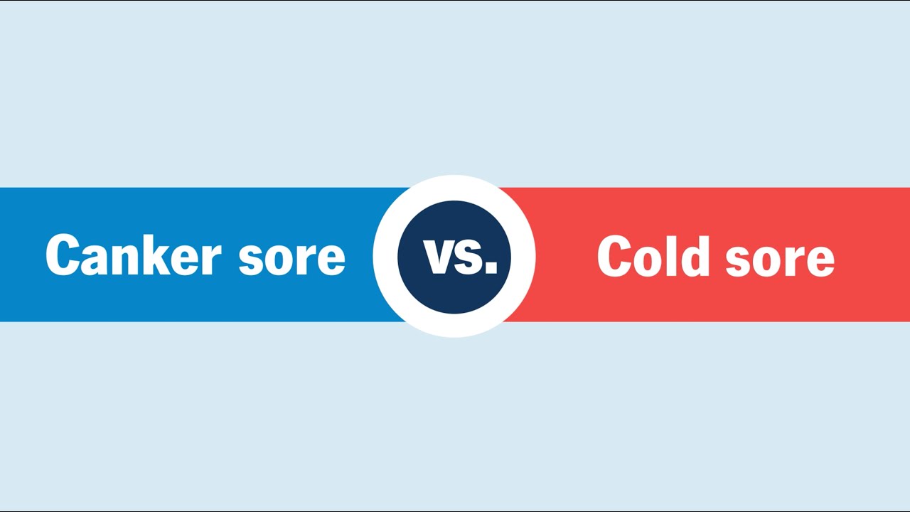Cold Sores vs. Canker Sores: Which Is It?