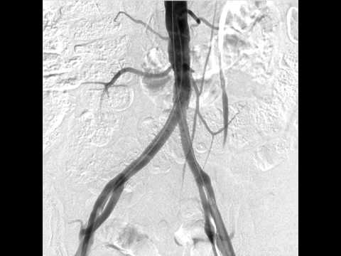 Artery now widely patent after stenting