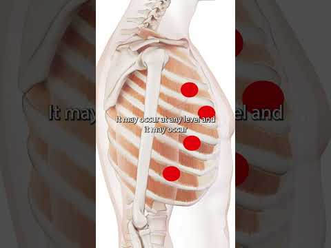 The Intercostal Muscle Trigger Points