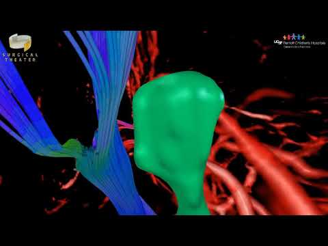 Focal Cortical Dysplasia Fly-Through